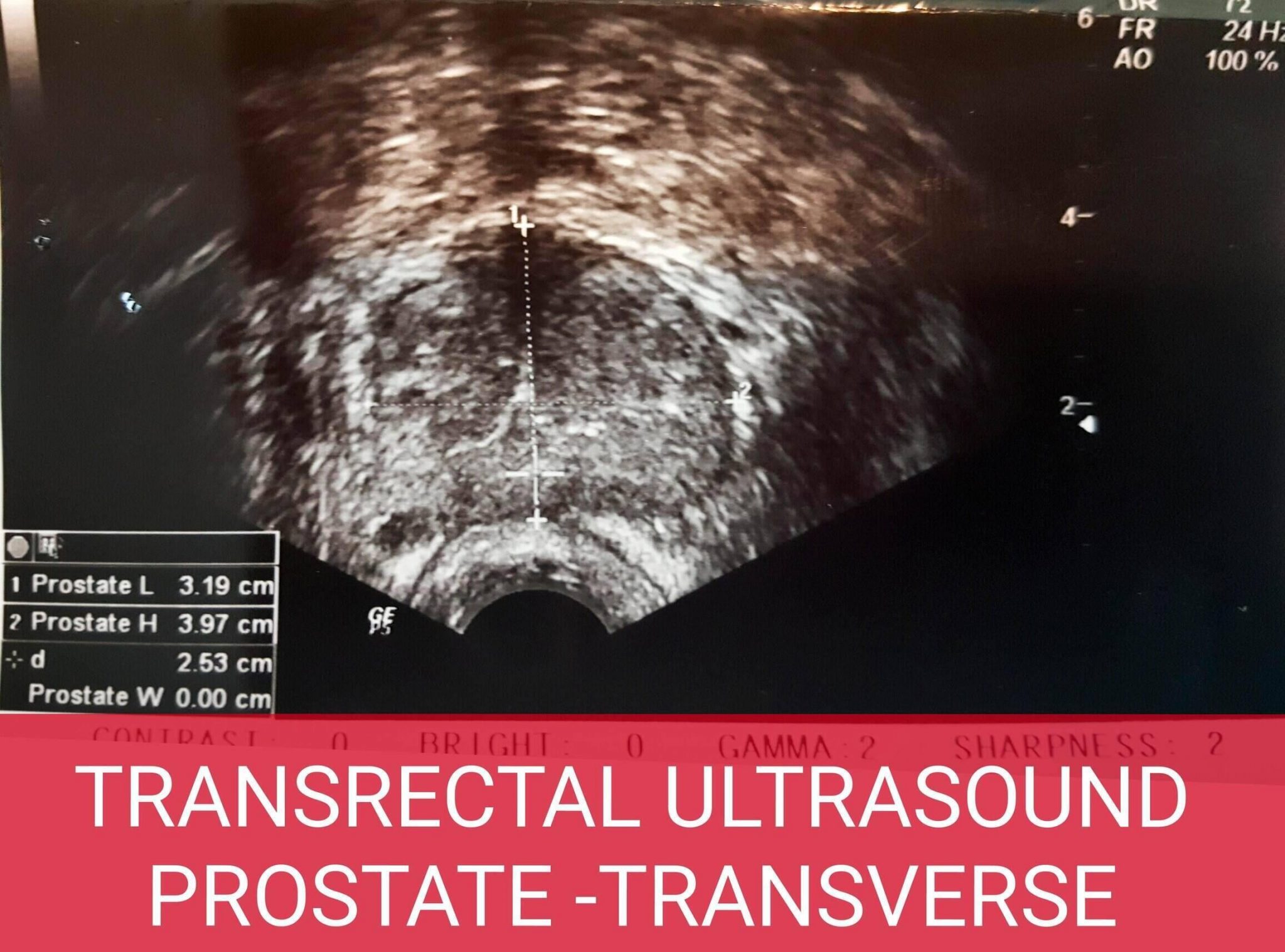 Transrectal Ultrasonography of the Prostate - Urology Malaysia